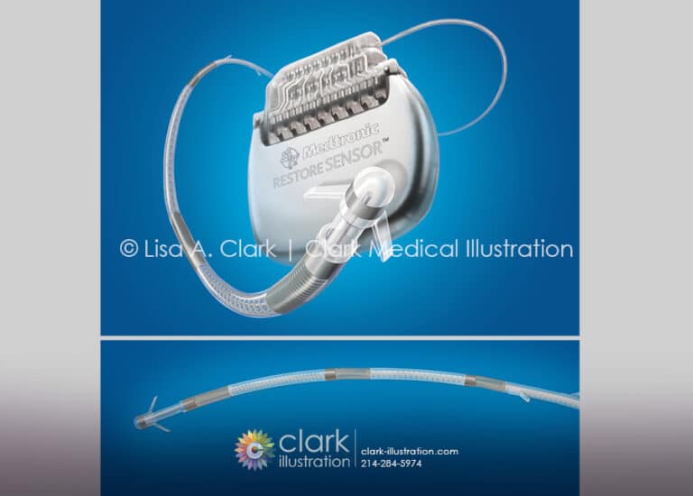 Medtronic Occipital Nerve Stimulation Device Illustration