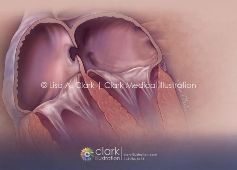 Patent Foramen Ovale (PFO) Illustration