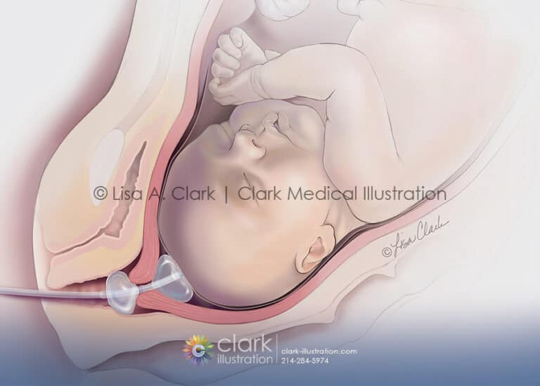 Cervical Ripening Balloon – Clark Medical Illustration